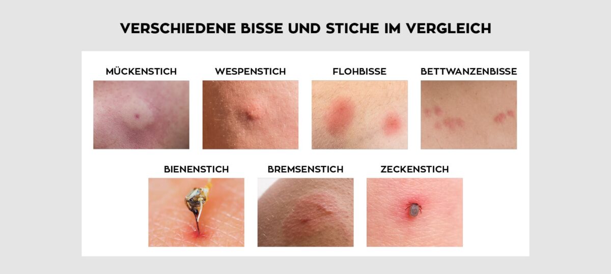 Insektenstiche So Lassen Sich Stiche Erkennen Behandeln DFNT Insektenstiche So Lassen Sich Stiche Erkennen Behandeln DFNT